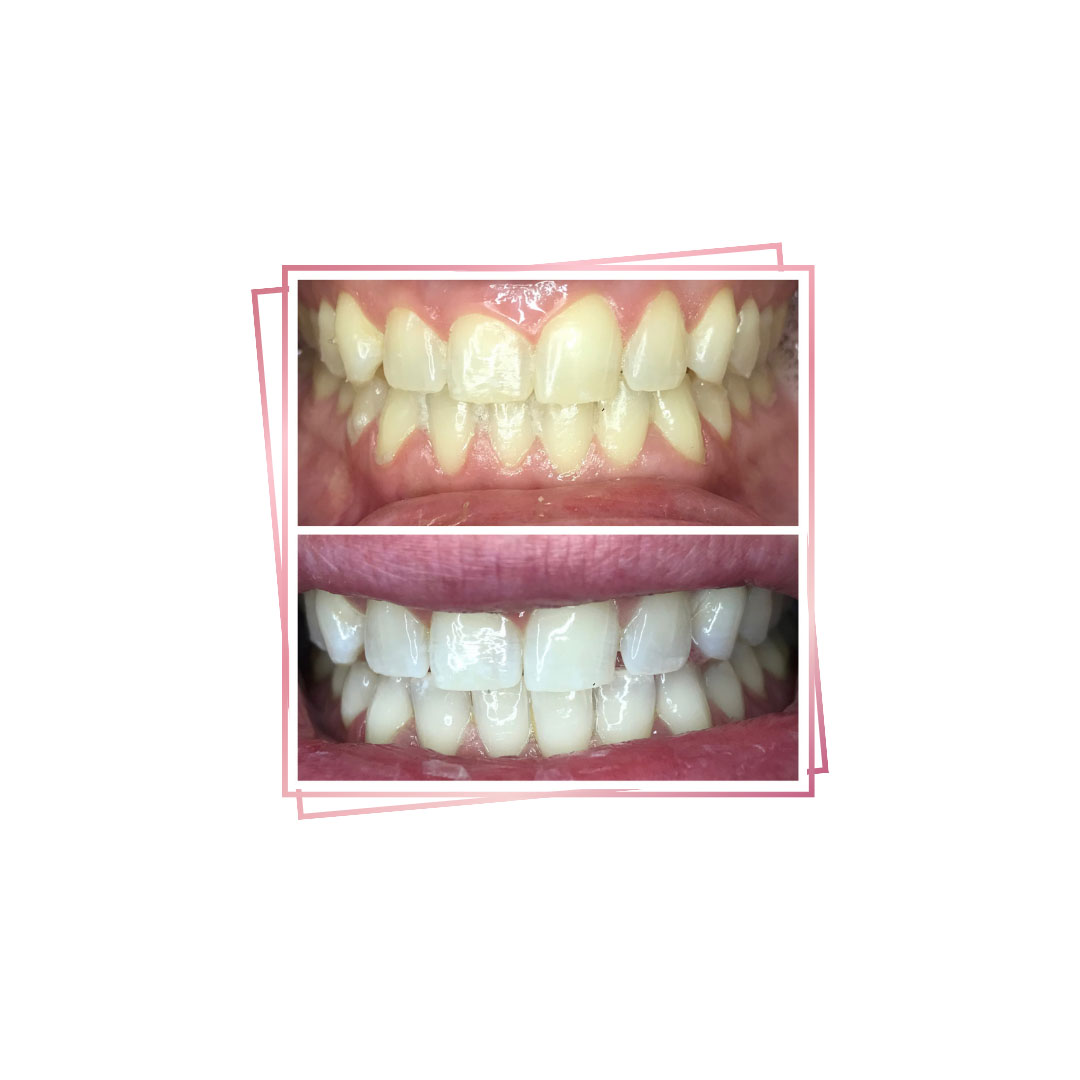 Results » Organic Radiance Teeth Whitening