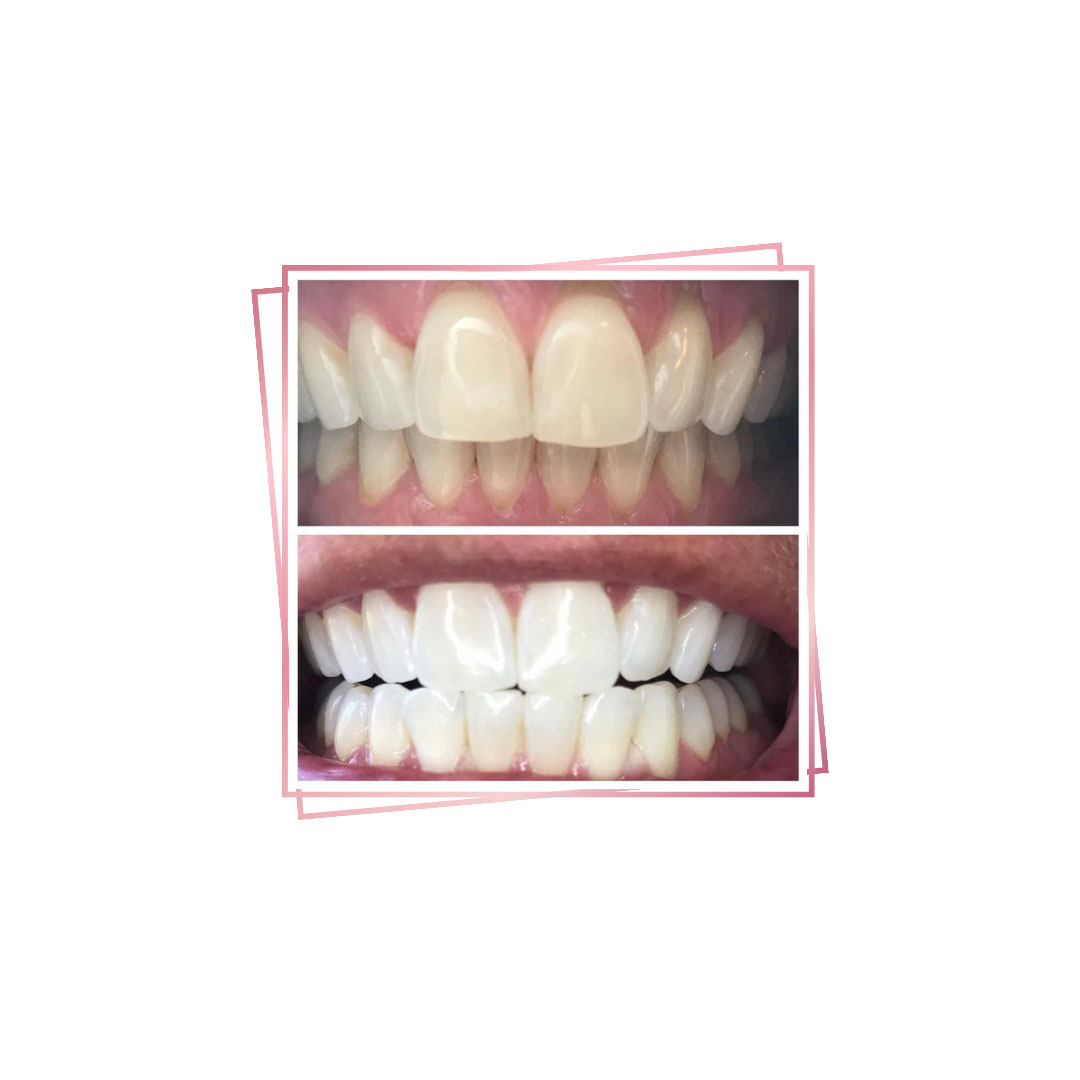 Results » Organic Radiance Teeth Whitening