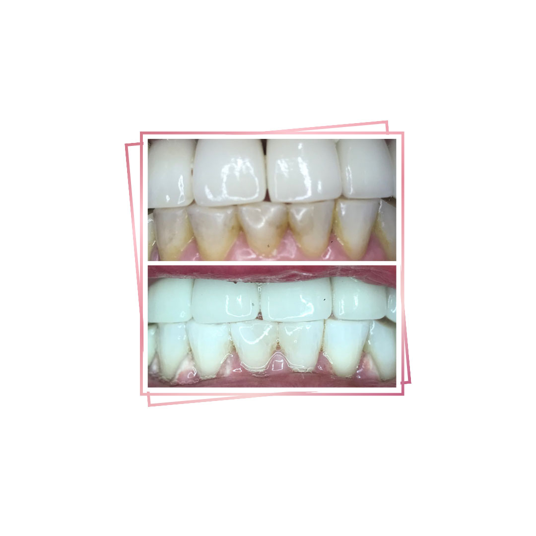 Results » Organic Radiance Teeth Whitening