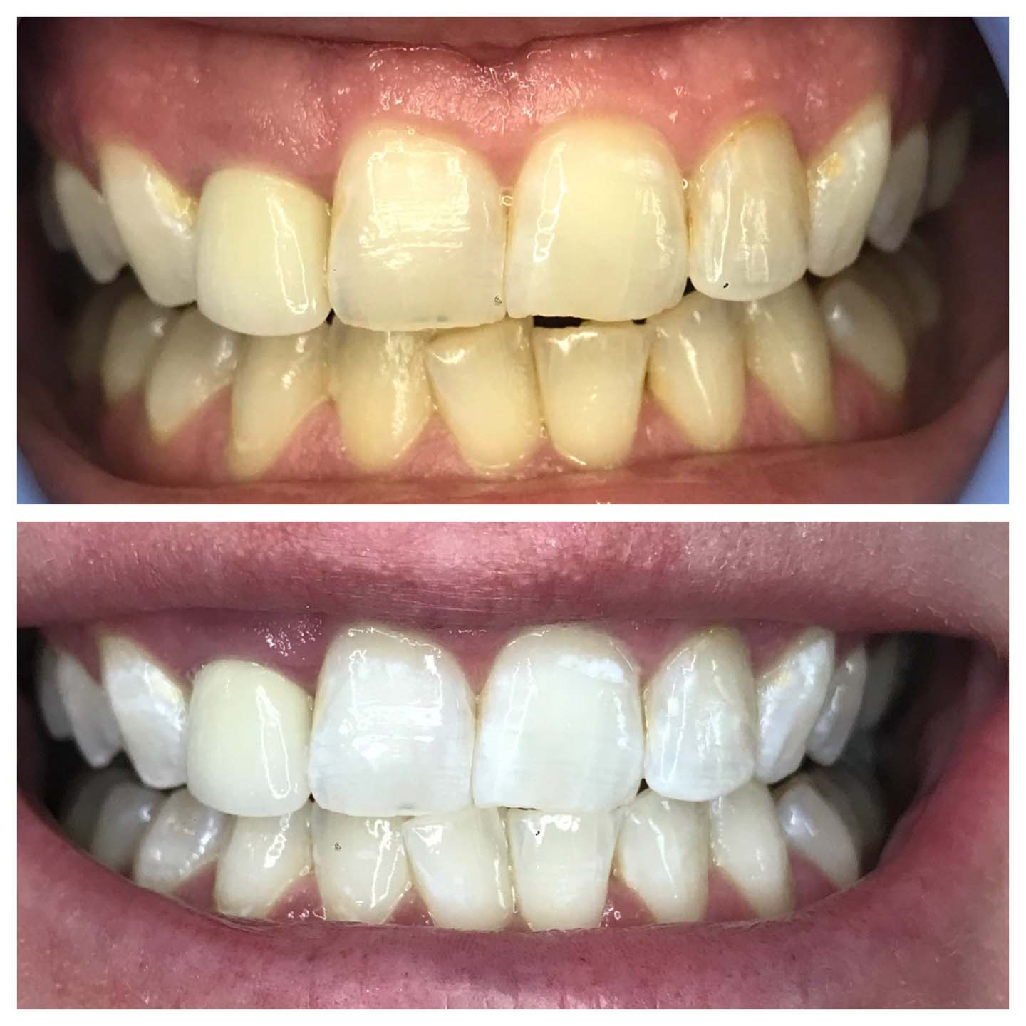 Results » Organic Radiance Teeth Whitening