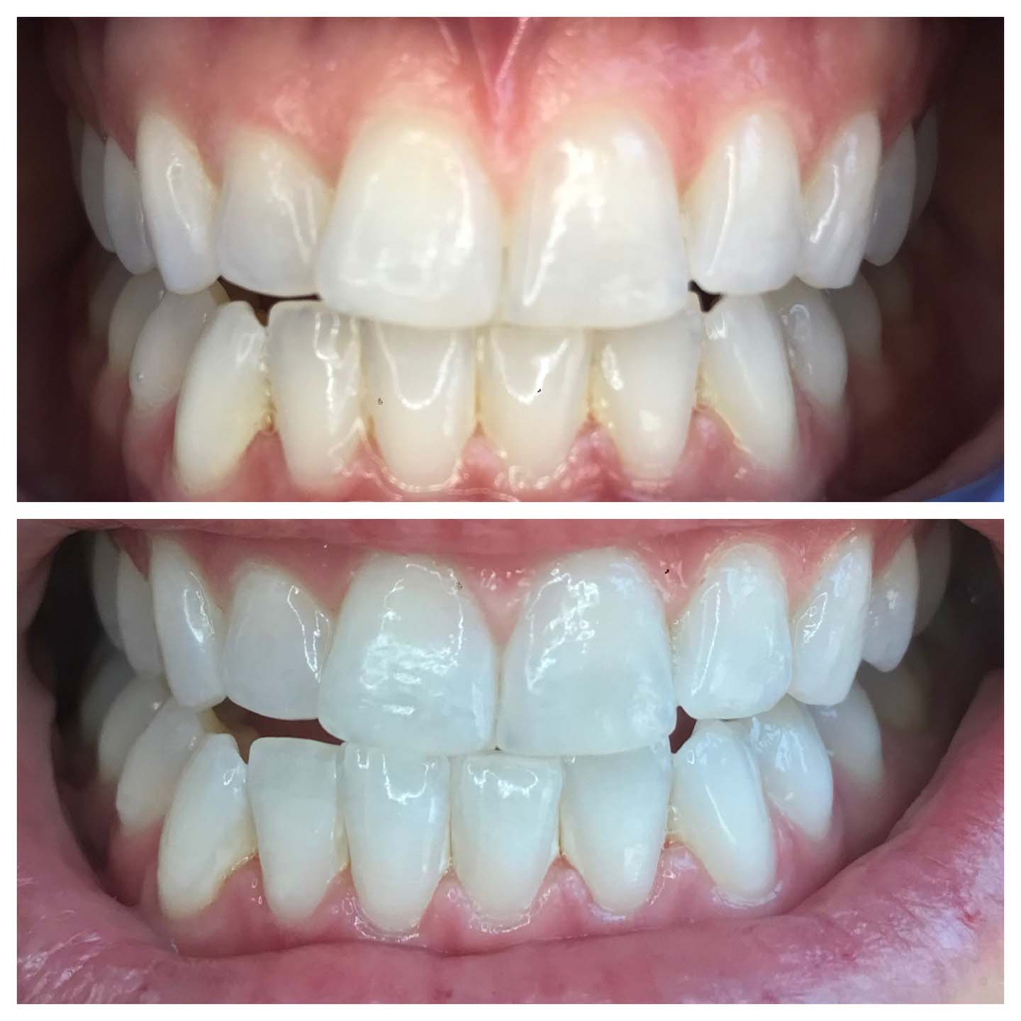 Results » Organic Radiance Teeth Whitening