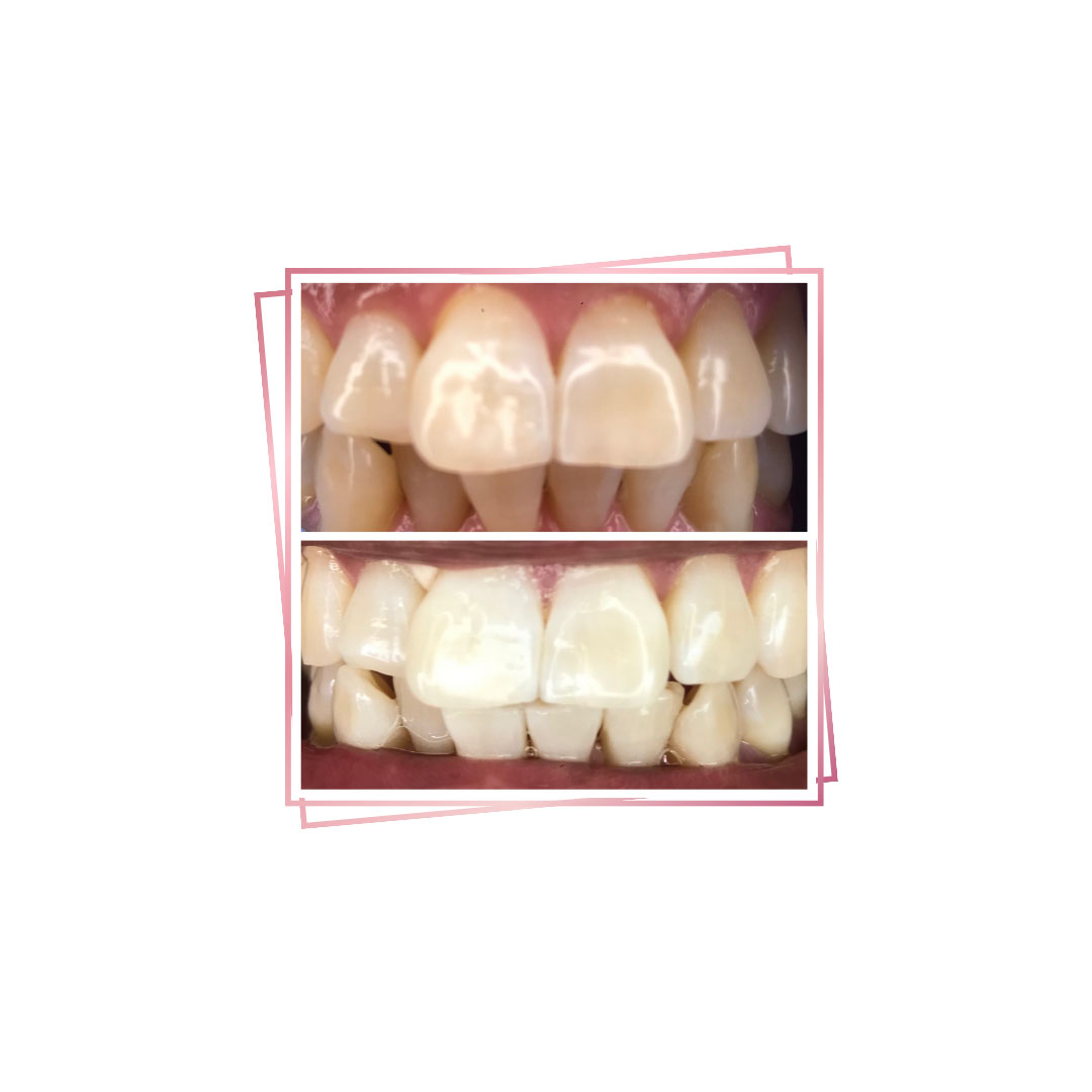 Results » Organic Radiance Teeth Whitening